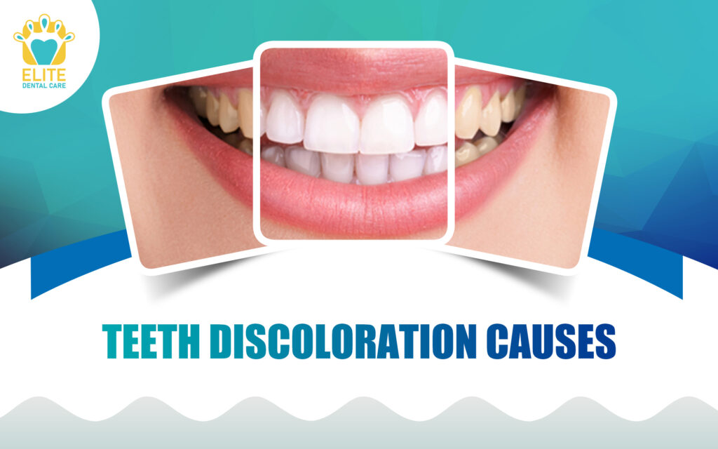 What is Treatment for Tooth Discoloration? - Elite Dental Care