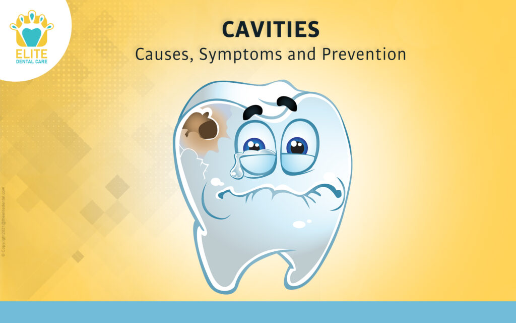 Cavities: Causes, Symptoms and Prevention - Elite Dental Care