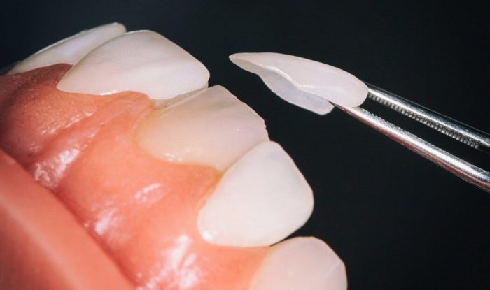 How Are Veneers Used In Dentistry Elite Dental Care Tracy