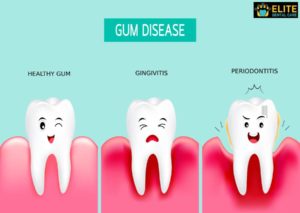 How to Know If You Have Gum Disease and What to Do About It – Elite ...