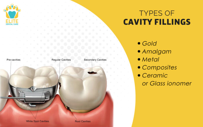 TYPES OF CAVITY FILLINGS - ELITE DENTAL CARE TRACY - Elite Dental Care