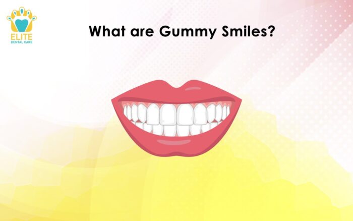 WHAT ARE GUMMY SMILES - Elite Dental Care