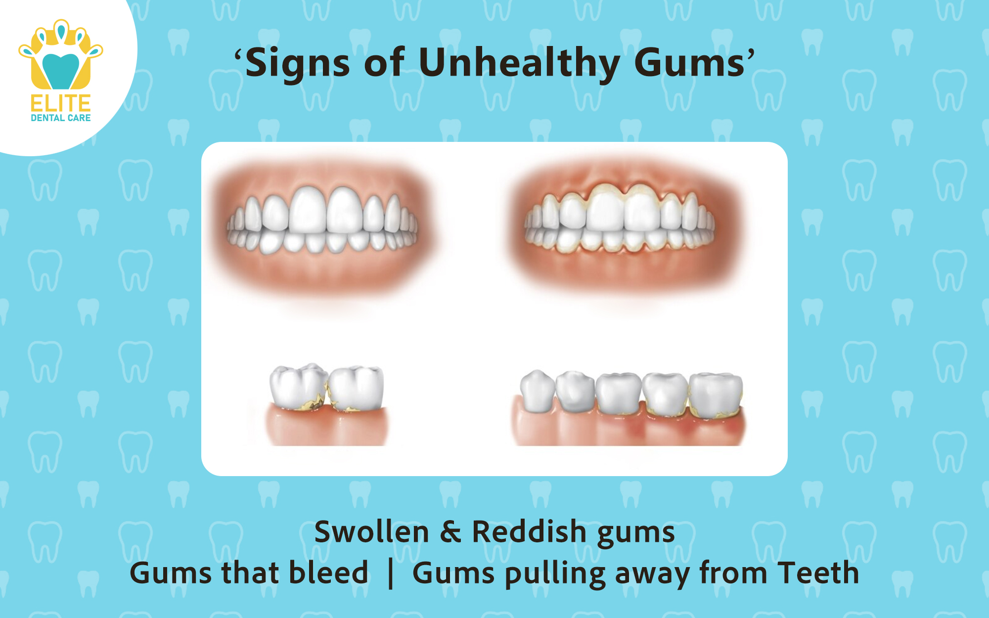 SIGNS OF UNHEALTHY GUMS Elite Dental Care