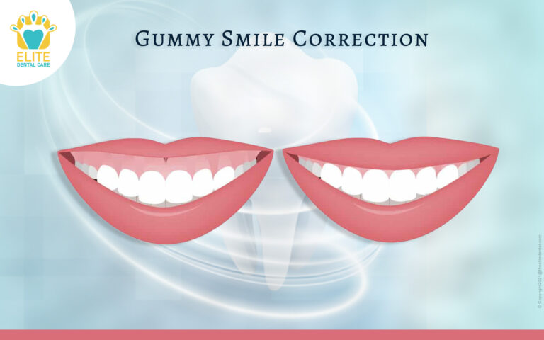 Gummy Smile Correction - Elite Dental Care