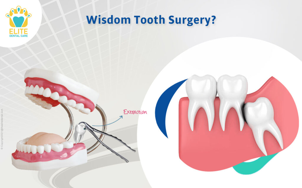 Wisdom Tooth Surgery: Everything You Need to Know! - Elite Dental Care