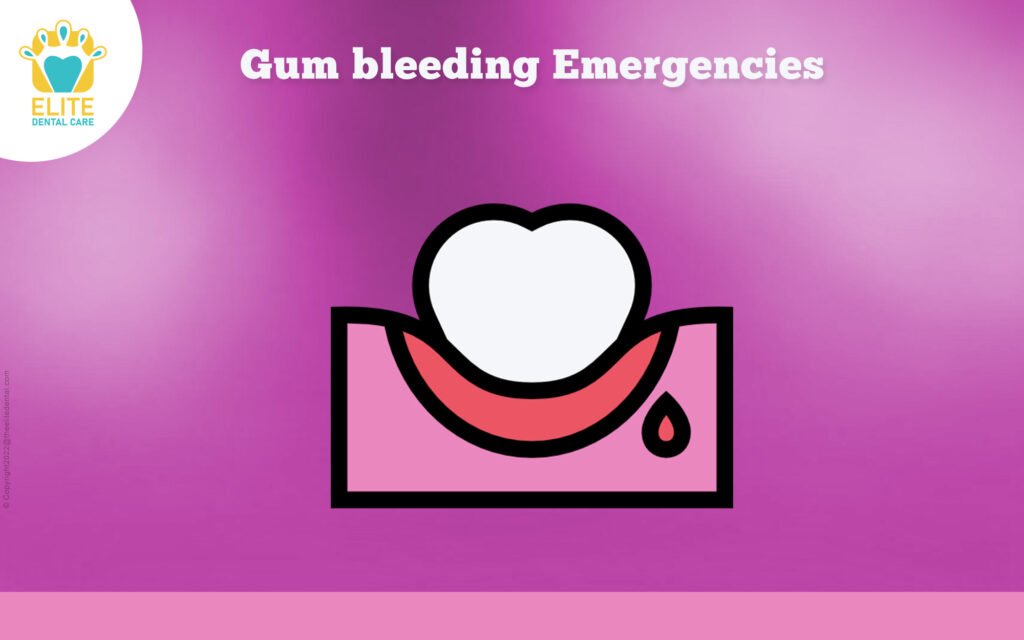Gum Bleeding Emergencies - Elite Dental Care