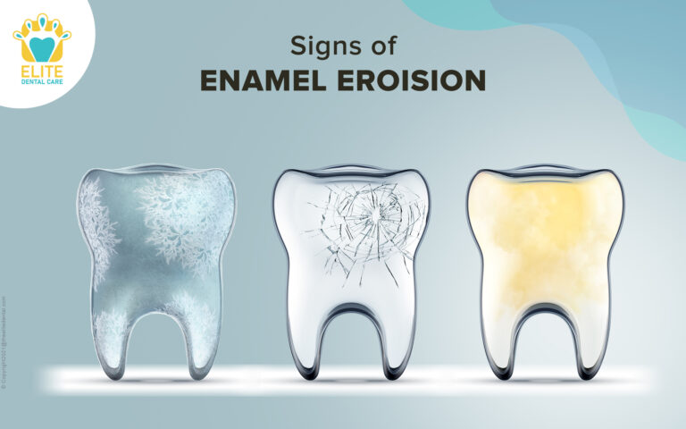 Signs of Enamel Erosion - Elite Dental Care