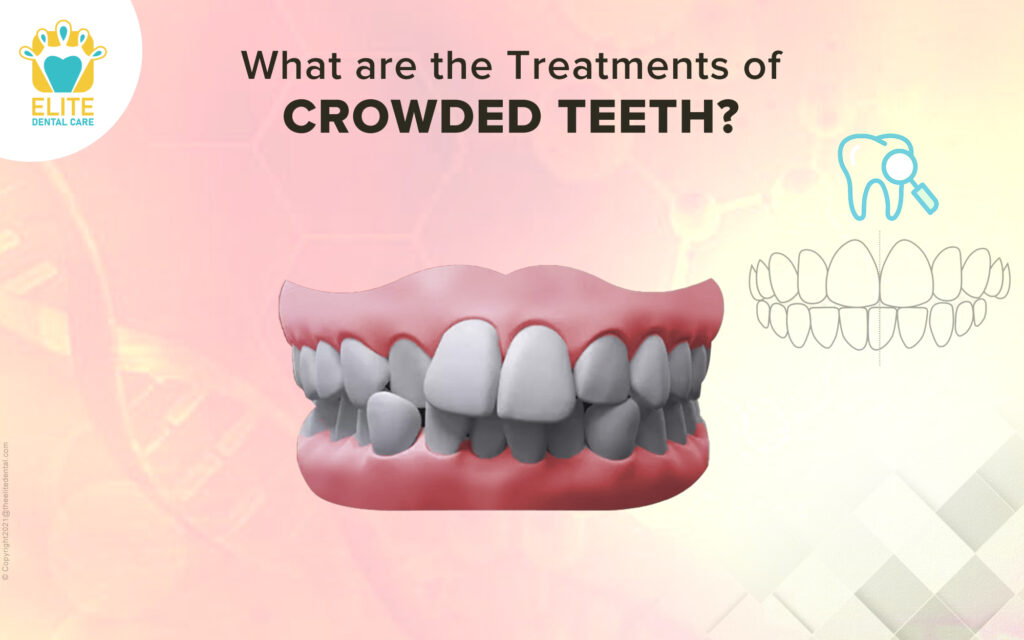 What are the Treatments for Crowded Teeth? - Elite Dental Care