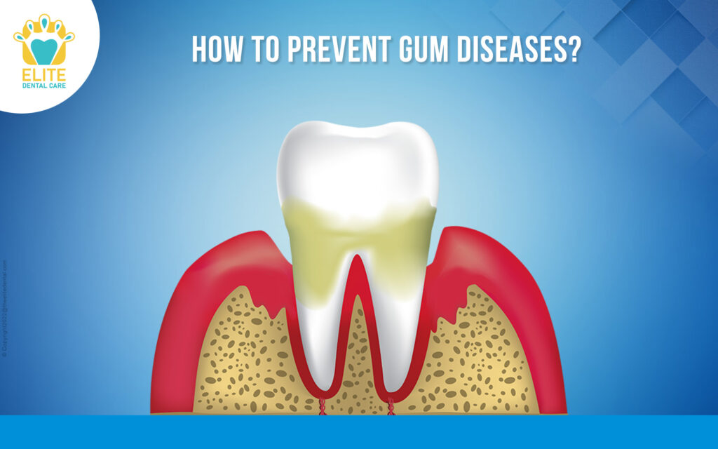 Stages of Gum Diseases - Elite Dental Care