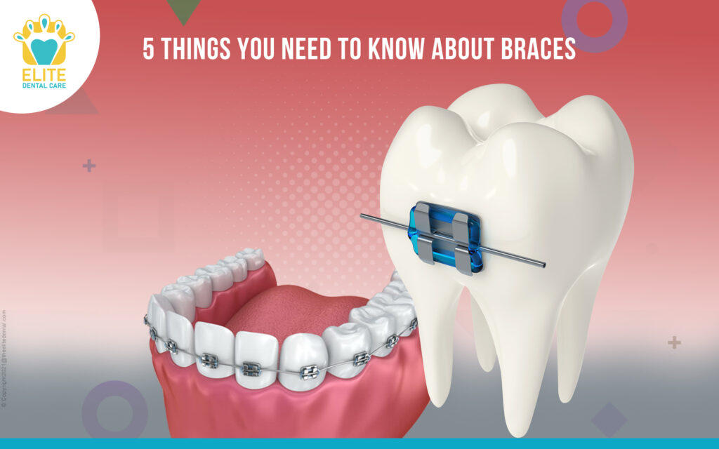 5 Things you need to know about braces - Elite Dental Care