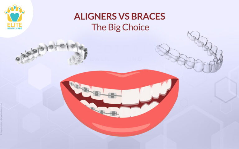 ALIGNERS VS BRACES – THE BIG CHOICE - Elite Dental Care