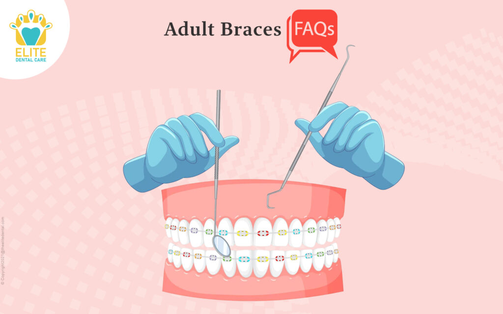 Adult Braces FAQs - Elite Dental Care