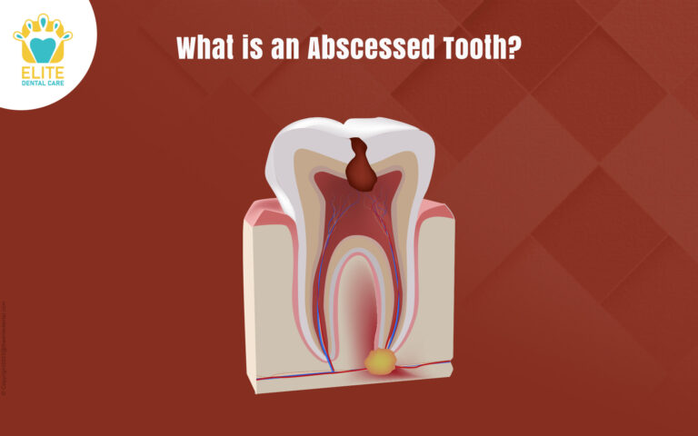 What is an Abscessed Tooth? - Elite Dental Care
