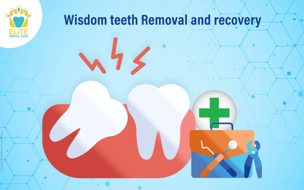 Timeline Of Wisdom Teeth Removal Recovery Elite Dental Care Timeline Of Wisdom Teeth Removal Recovery Elite Dental Care