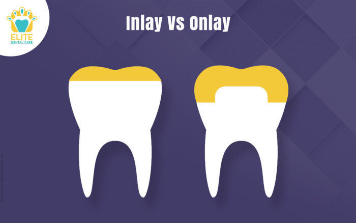 Inlay Vs Onlay - Elite Dental Care