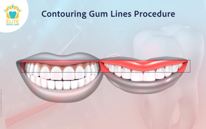 Contouring Gum Lines Procedure - Elite Dental Care