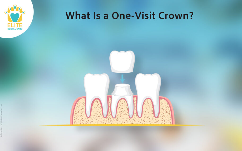What is One-Visit Crown? - Elite Dental Care