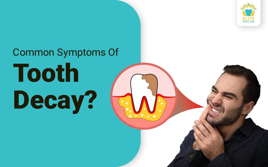 Common Symptoms of Tooth Decay - Elite Dental Care
